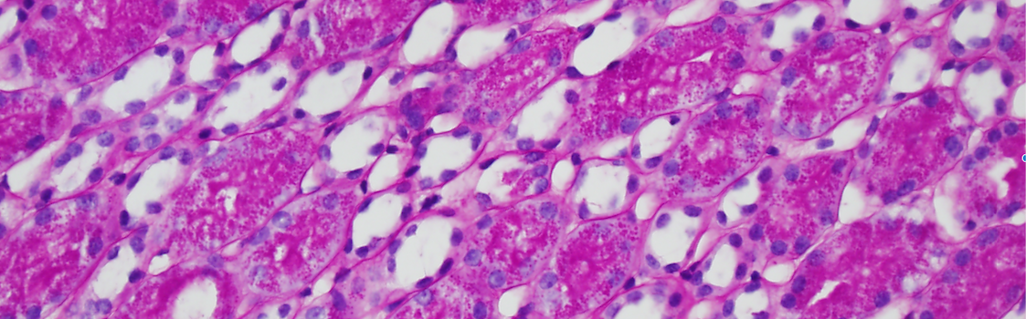 nephrotic syndrome – American Society of Pediatric Nephrology (ASPN)