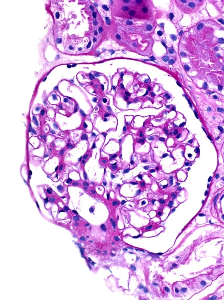 Endocapillary hypercellularity - American Society of Pediatric ...