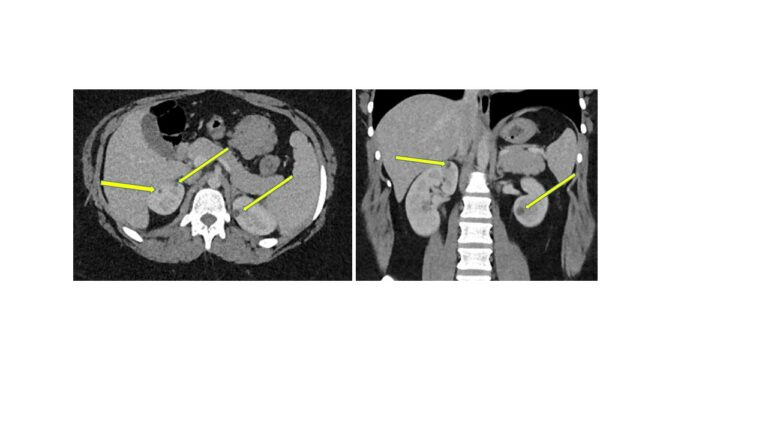 CT scan showing bilateral renal cysts (arrows) in normal sized kidneys ...