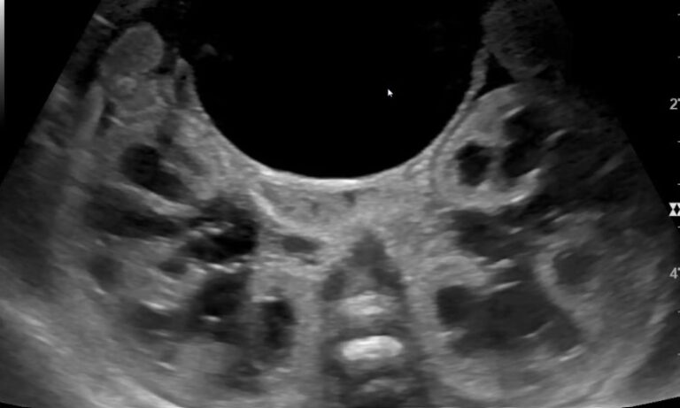 Prenatal ultrasound showing distended bilateral renal hydronephrosis ...