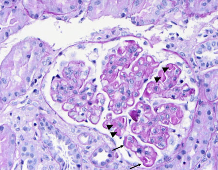 SLE nephritis - American Society of Pediatric Nephrology (ASPN)