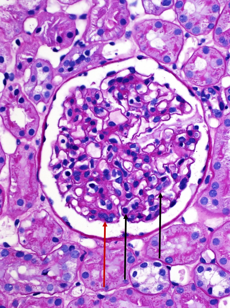 Endocapillary hypercellularity - American Society of Pediatric Nephrology (ASPN)
