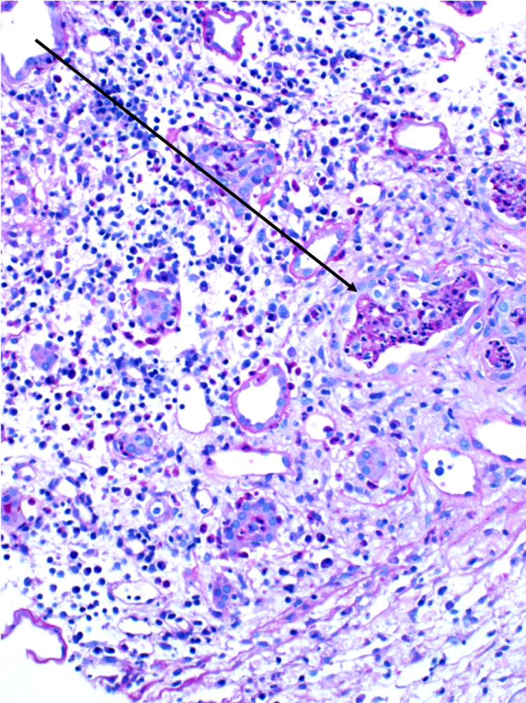 acute interstitial nephritis Archives - American Society of Pediatric ...