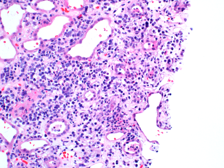 acute interstitial nephritis Archives - American Society of Pediatric ...