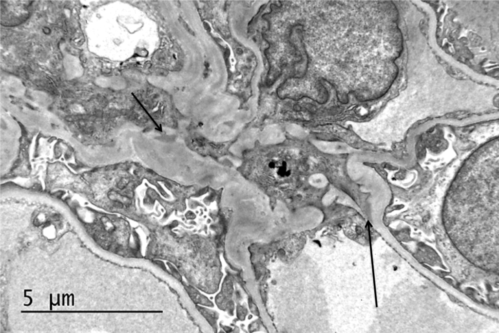 mesangium – American Society of Pediatric Nephrology (ASPN)